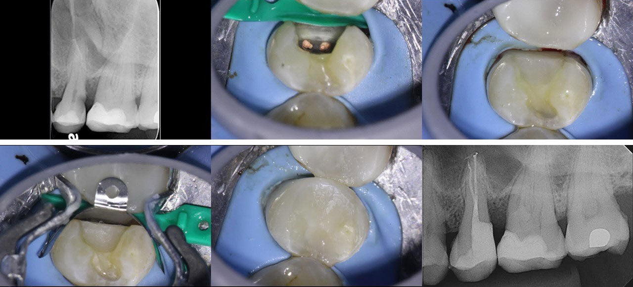 Deep Margin Elevation (DME) in Endodontic Restorative Cases: Why the D